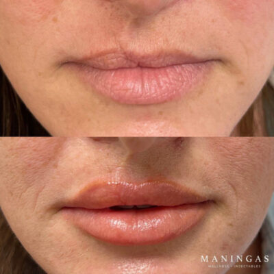 Russian Lips, Cherry Lips, Keyhole Lips: 3 Lip Filler Trends, Explained ...