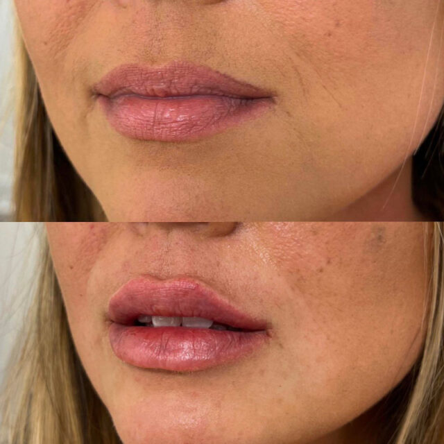 Russian Lips, Cherry Lips, Keyhole Lips: 3 Lip Filler Trends, Explained ...