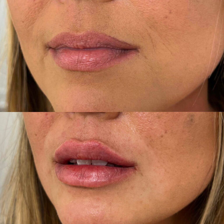 Russian Lips, Cherry Lips, Keyhole Lips: 3 Lip Filler Trends, Explained ...